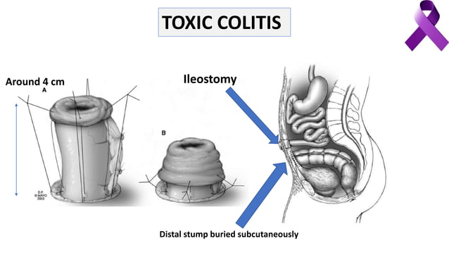 Ulcerative colitis complications management | PPTX