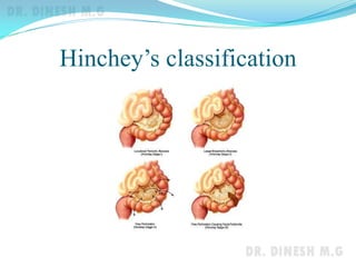 Ulcerative colitis & Diverticulosis | PPT