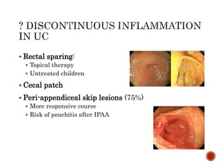 Ulcerative colitis by Dr. Ali Hasan | PPT
