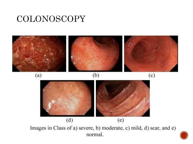 Ulcerative colitis by Dr. Ali Hasan
