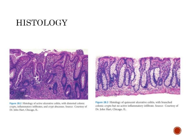 Ulcerative colitis by Dr. Ali Hasan