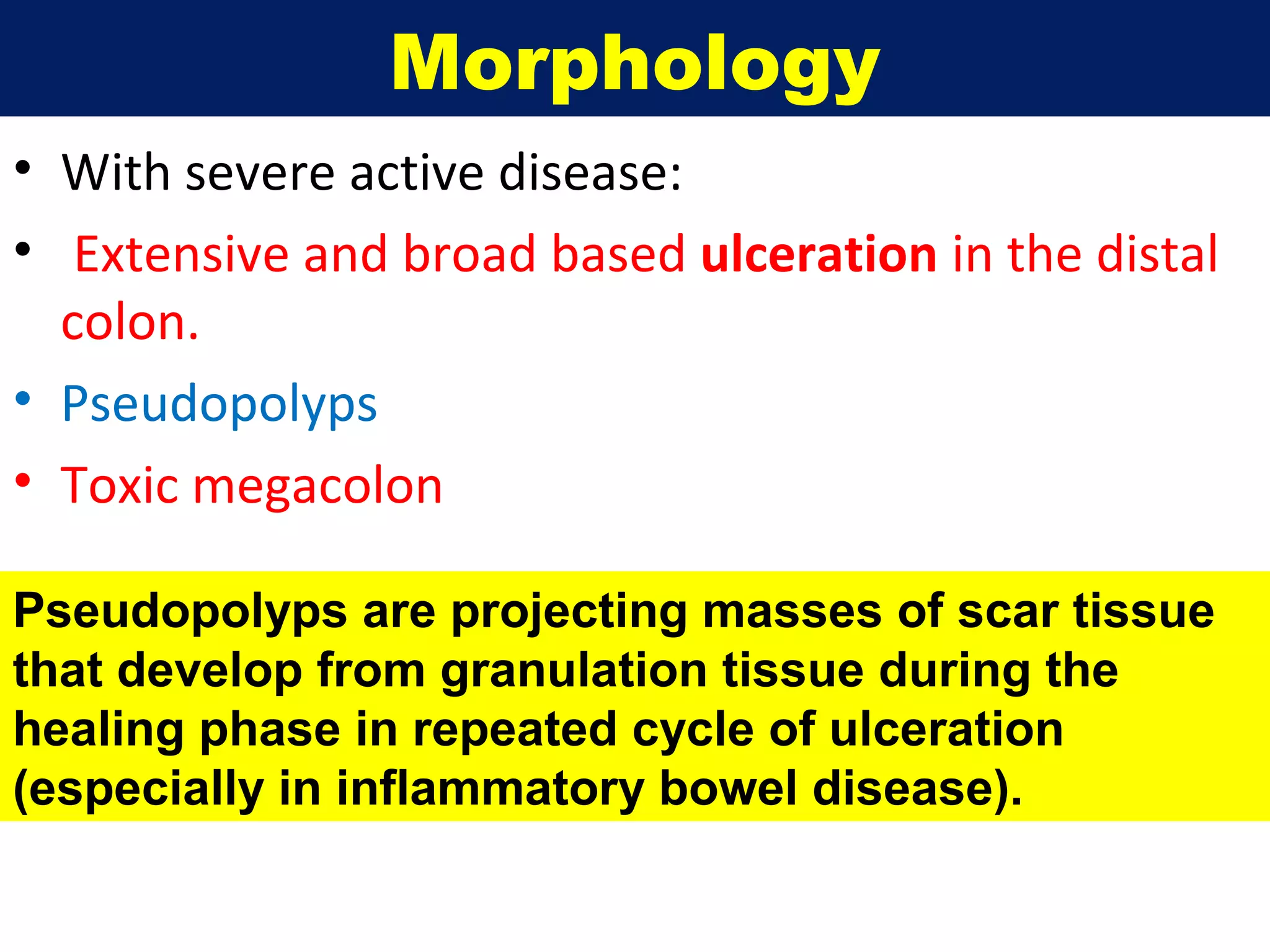 Ulcerative colitis, classification, causes,clinical features ...