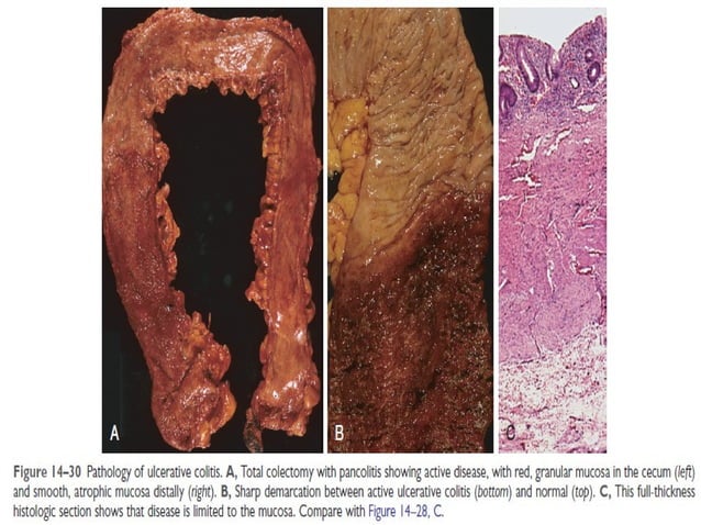 Ulcerative colitis, classification, causes,clinical features ...