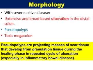 Ulcerative colitis, classification, causes,clinical features ...