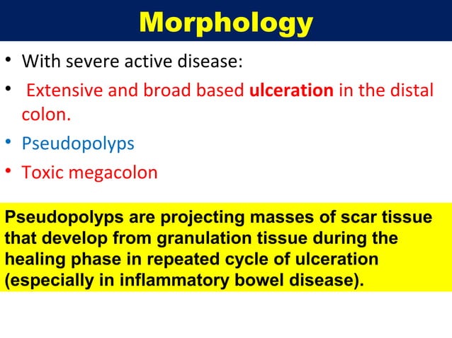 Ulcerative colitis, classification, causes,clinical features ...