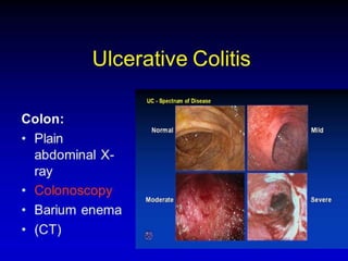 Ulcerative colitis ppt easy med notes 2021 | PPT