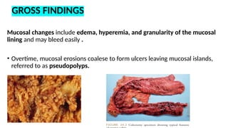 Ulcerative colitis, Toxic megacolon surgical management.pptx