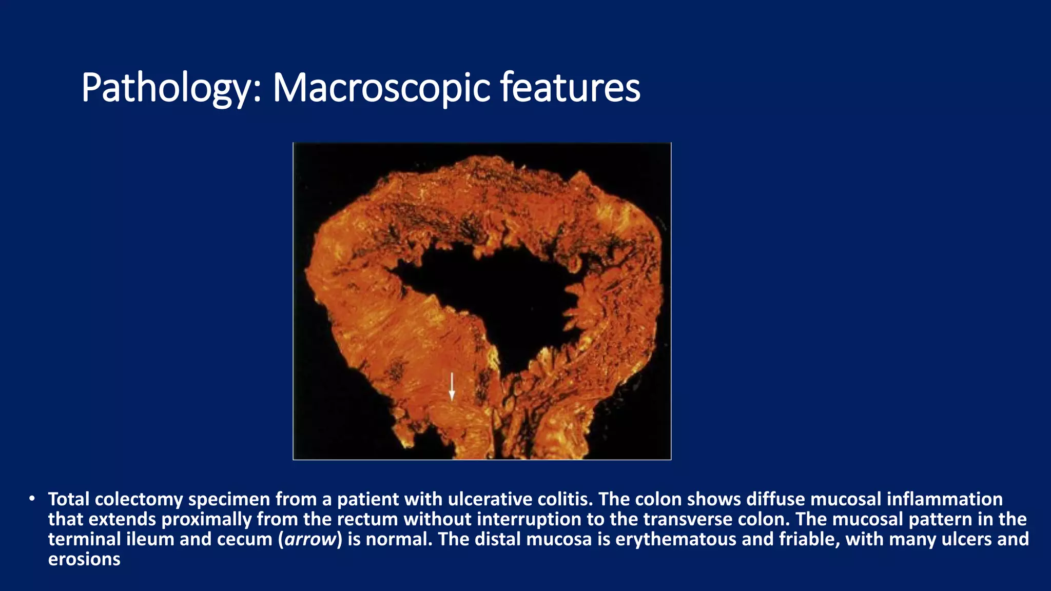 Ulcerative collitis | PPTX