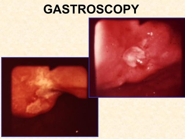 Ulcerative disease of the stomach and duodenum | PPT | Digestive ...