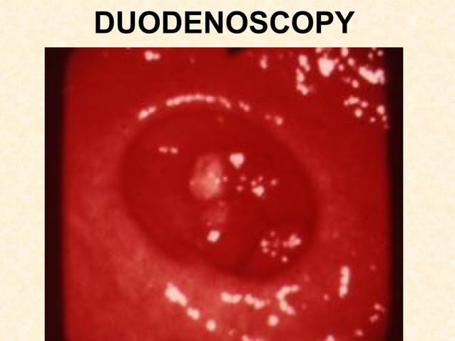 Ulcerative disease of the stomach and duodenum | PPT | Digestive ...