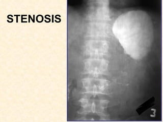 Ulcerative disease of the stomach and duodenum | PPT