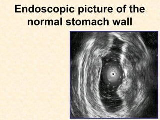 Ulcerative disease of the stomach and duodenum | PPT