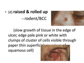 Ulcer drneerajjain | PDF