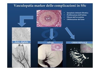 Ulcere digitali sclerodermiche.ppt [compatibility mode] | PDF
