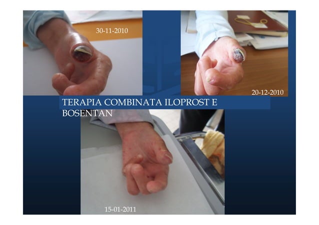 Ulcere digitali sclerodermiche.ppt [compatibility mode] | PDF