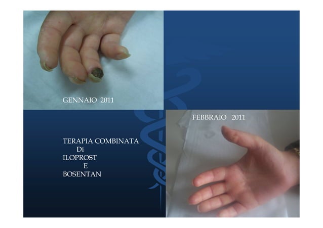 Ulcere digitali sclerodermiche.ppt [compatibility mode] | PDF