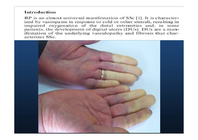 Ulcere digitali sclerodermiche.ppt [compatibility mode] | PDF