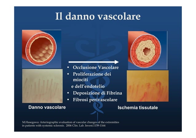 Ulcere digitali sclerodermiche.ppt [compatibility mode] | PDF