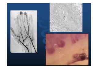 Ulcere digitali sclerodermiche.ppt [compatibility mode] | PDF