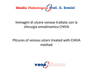 Venous ulcers treated with CHIVA method | PPT