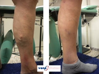 Venous ulcers treated with CHIVA method | PPT