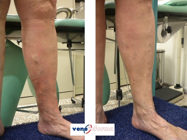 Venous ulcers treated with CHIVA method | PDF