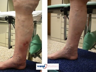 Venous ulcers treated with CHIVA method | PPT
