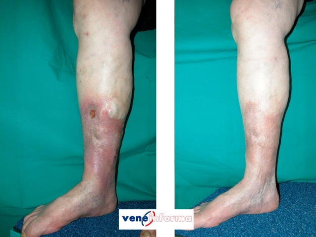Venous ulcers treated with CHIVA method | PDF