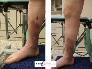 Venous ulcers treated with CHIVA method | PPT