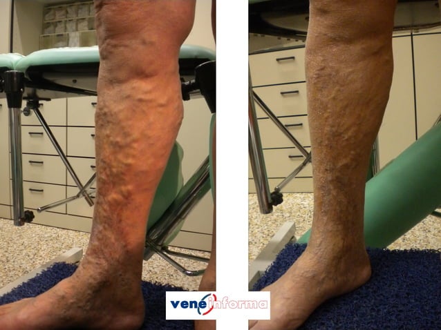 Venous ulcers treated with CHIVA method | PPT