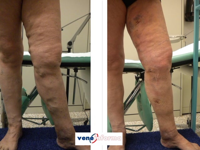 Venous ulcers treated with CHIVA method | PDF