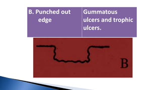 Ulcer examination | PPTX
