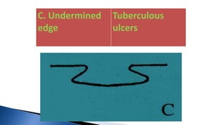 Ulcer examination | PPTX