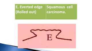Ulcer examination | PPTX