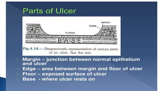 Ulcer examination | PPTX