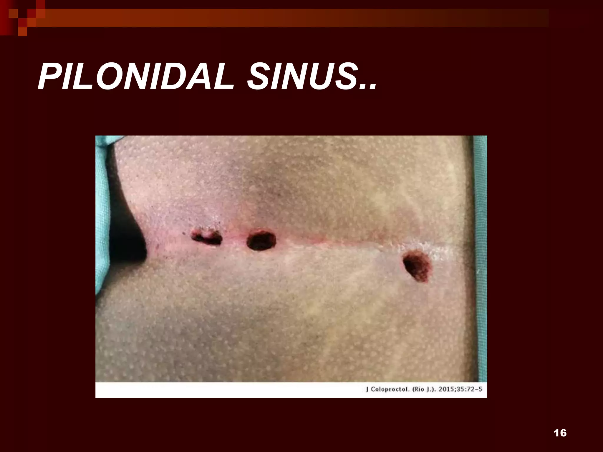 ULCER FISTULA SINUS/BASIC KNWOLEDGE.ppt