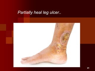 ULCER FISTULA SINUS/BASIC KNWOLEDGE.ppt