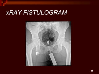 ULCER FISTULA SINUS/BASIC KNWOLEDGE.ppt