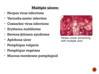 ulcer_history_presentation final bds.pptx