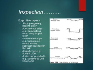 Ulcer presentation | PPTX