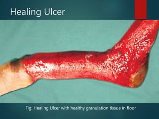 Ulcer presentation | PPTX