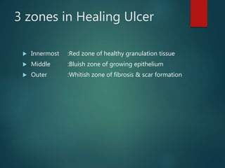 Ulcer presentation | PPTX