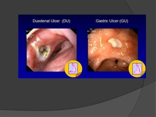 Ulcers | PPTX