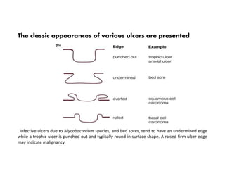 Ulcers | PPTX