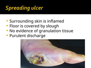 ULCERS, classification, presentation.ppt