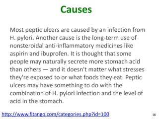 Ulcers | PPTX
