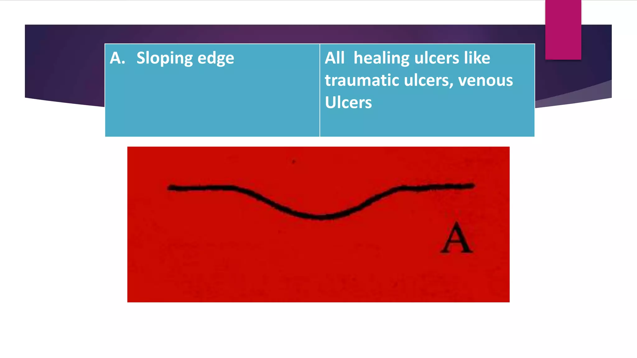 Ulcers Basics | PPTX