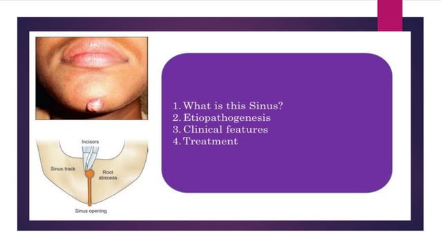 Ulcer, sinus and fistula/ pbl case scenario triggers | PPT