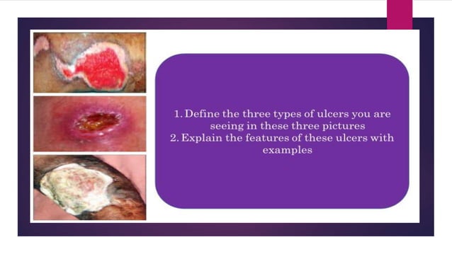 Ulcer, sinus and fistula/ pbl case scenario triggers | PPT