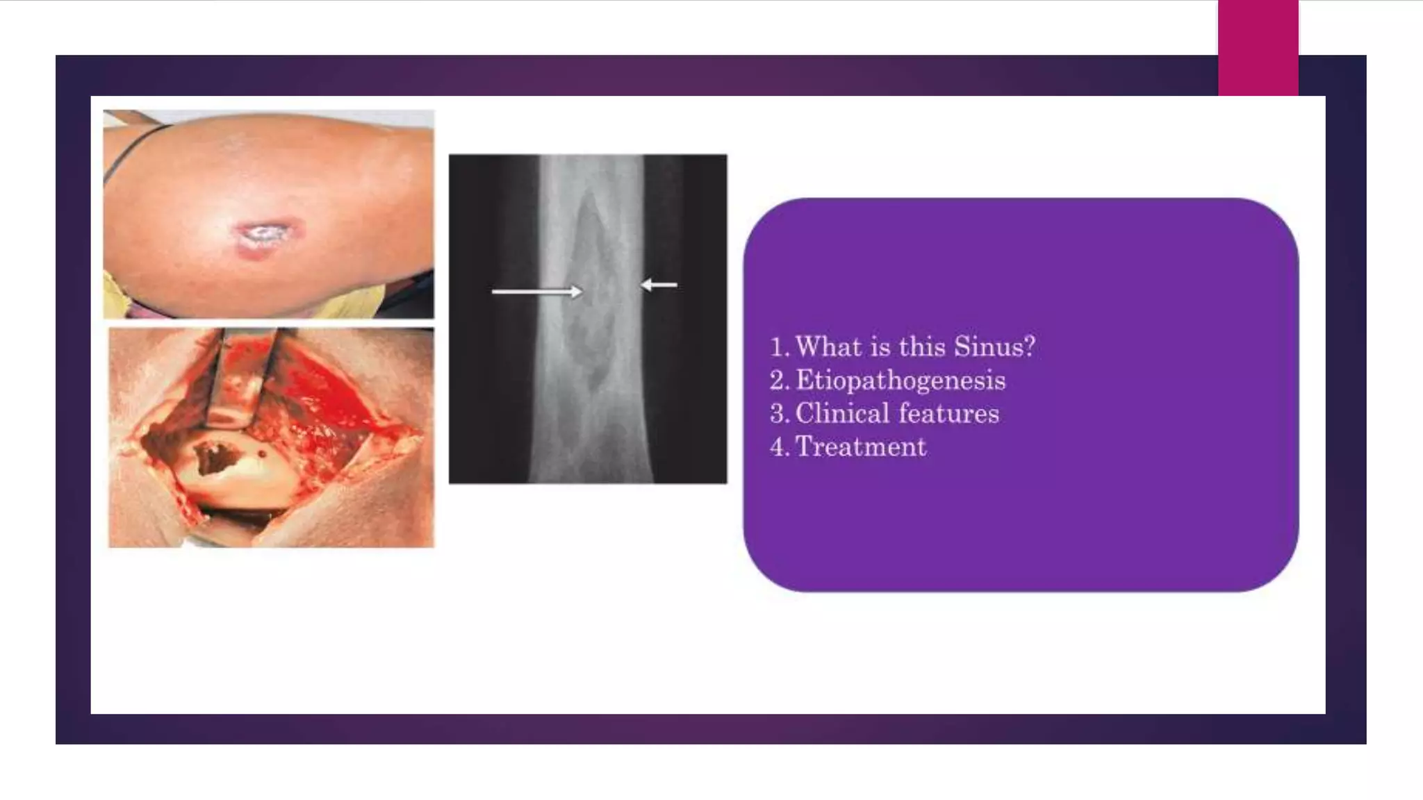 Ulcer, sinus and fistula pbl case scenario triggers | PPTX